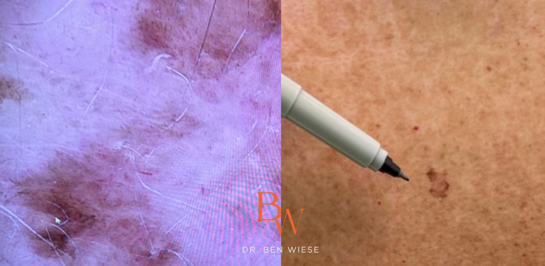 Skin Cancer Gallery | Dr. Ben Wiese – Kelowna, BC