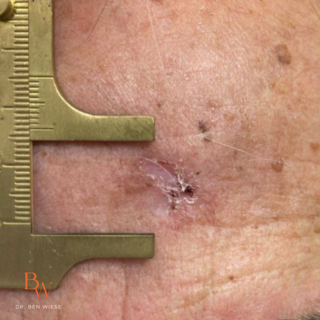Skin Cancer Gallery | Dr. Ben Wiese – Kelowna, BC