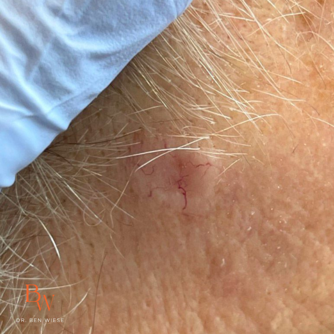 Skin Cancer Gallery | Dr. Ben Wiese | Kelowna, BC