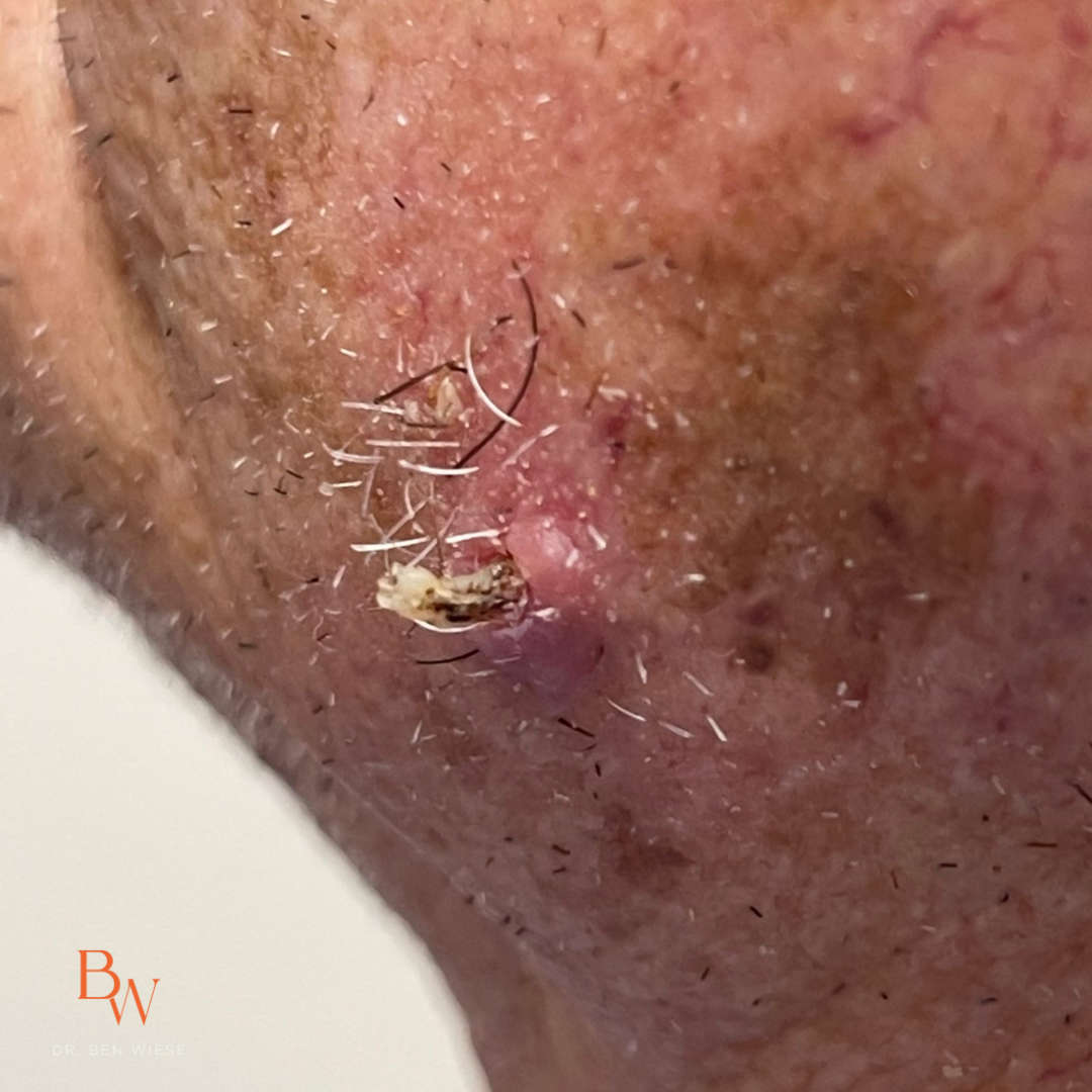 Skin Cancer Gallery | Dr. Ben Wiese – Kelowna, BC